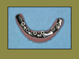 Introduction to Fixed Hybrid Surgery and Restoration - Implantology ...